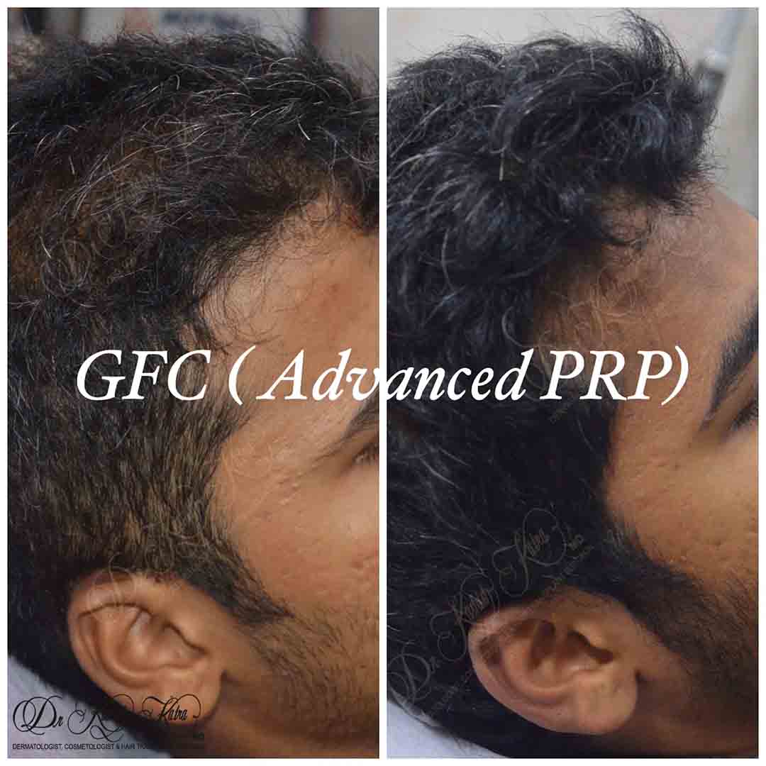 Advanced PRP Treatment in Delhi (GFC) | Hair Loss Treatment in Delhi
